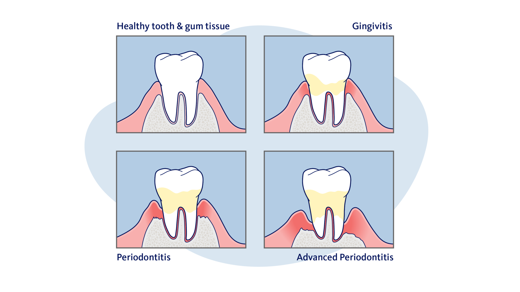 Geistlich China: 牙周炎