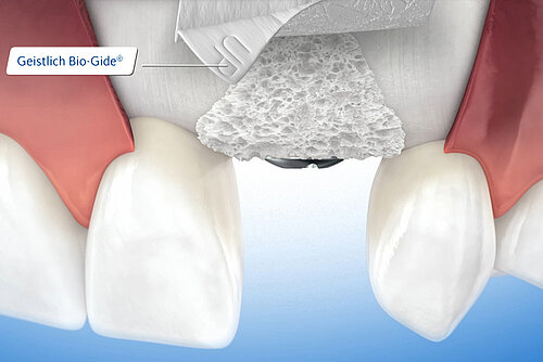 Geistlich China: 小面积骨增量