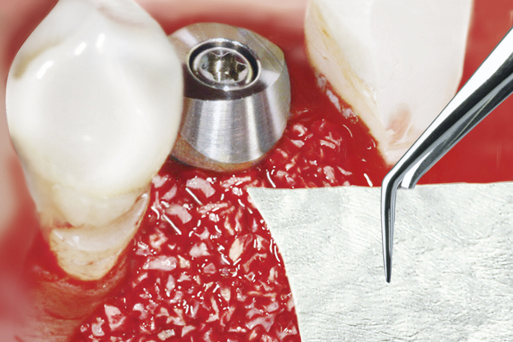 Geistlich China: Geistlich Bio-Gide